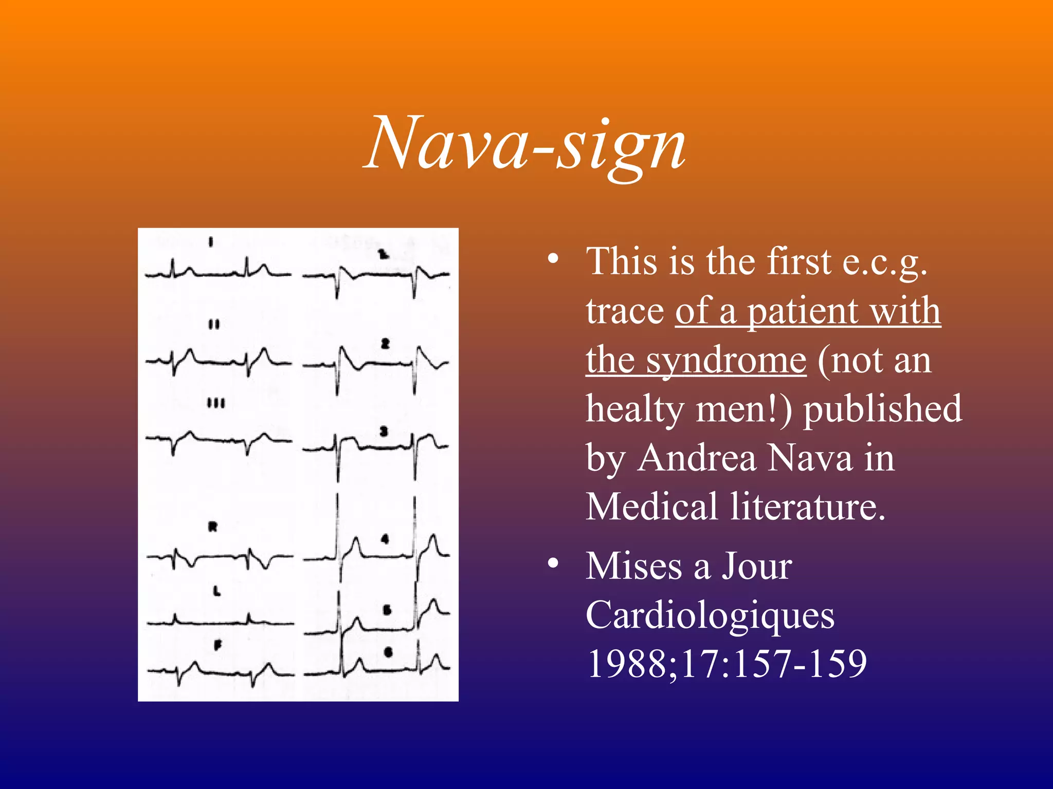 The so Called Brugada Syndrome The True History | PPT