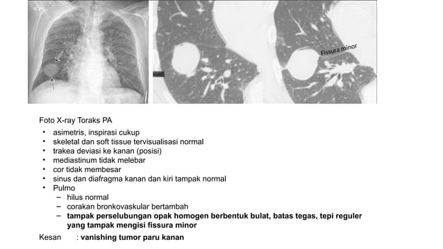 Contoh Soal-Soal Koas Radiologi Matrikulasi | PPT