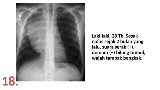 Contoh Soal-Soal Koas Radiologi Matrikulasi | PPT