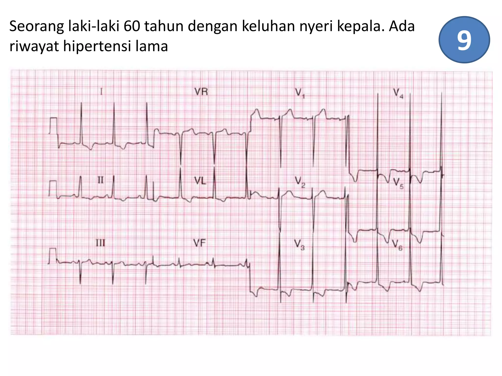 SOAL UJIAN EKG | PPTX