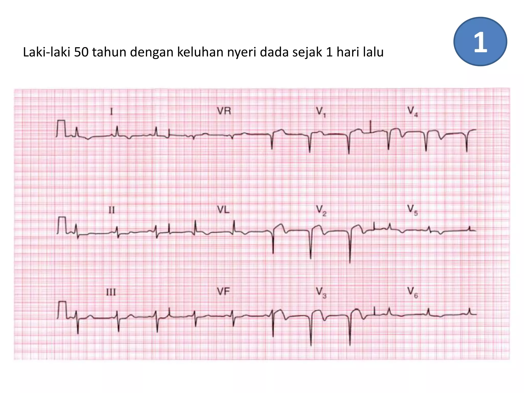 SOAL UJIAN EKG | PPTX