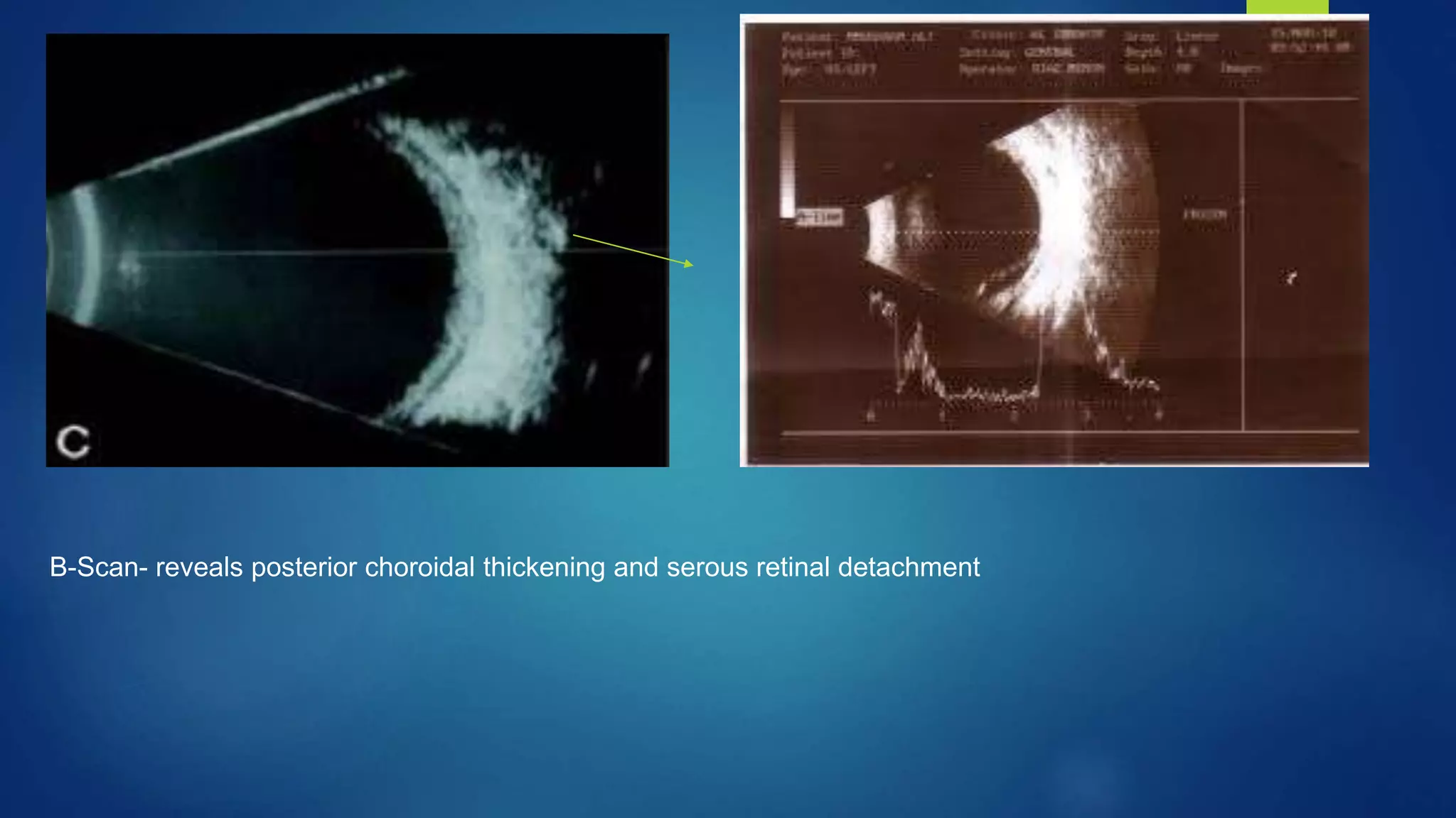 SYMPATHETIC OPHTHALMIA & VKH SYNDROME | PPTX