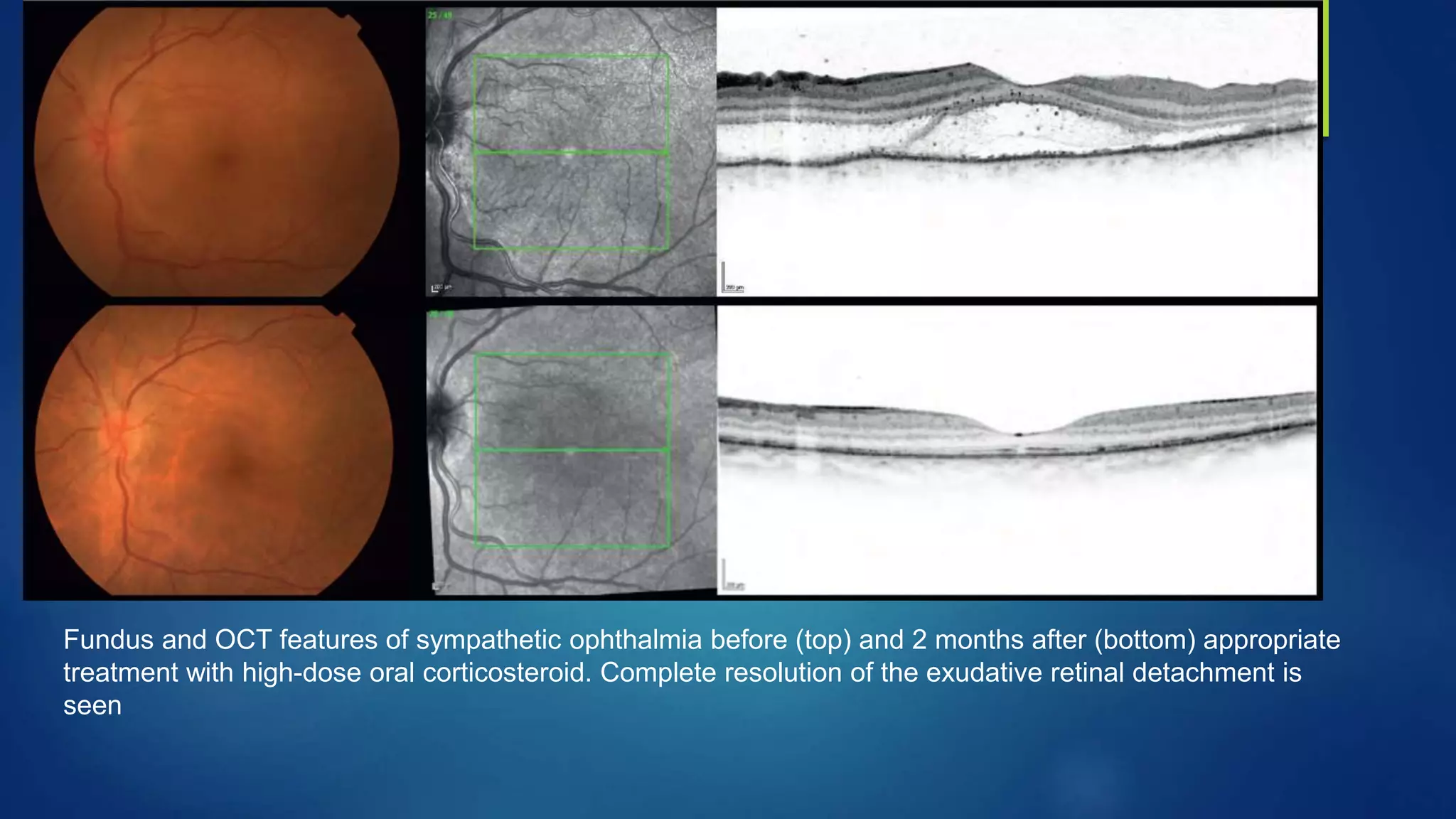 SYMPATHETIC OPHTHALMIA & VKH SYNDROME | PPTX