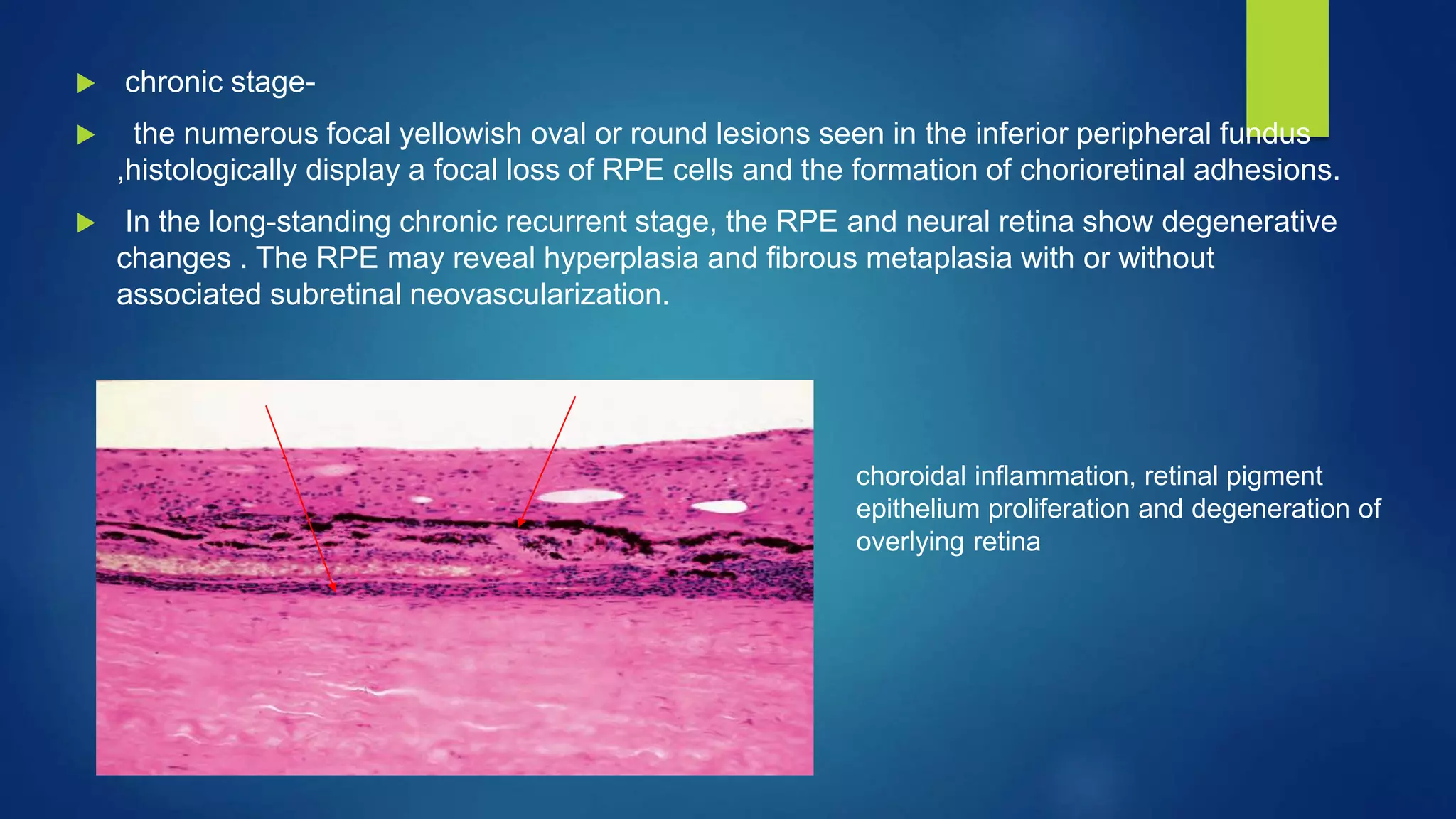 SYMPATHETIC OPHTHALMIA & VKH SYNDROME | PPTX