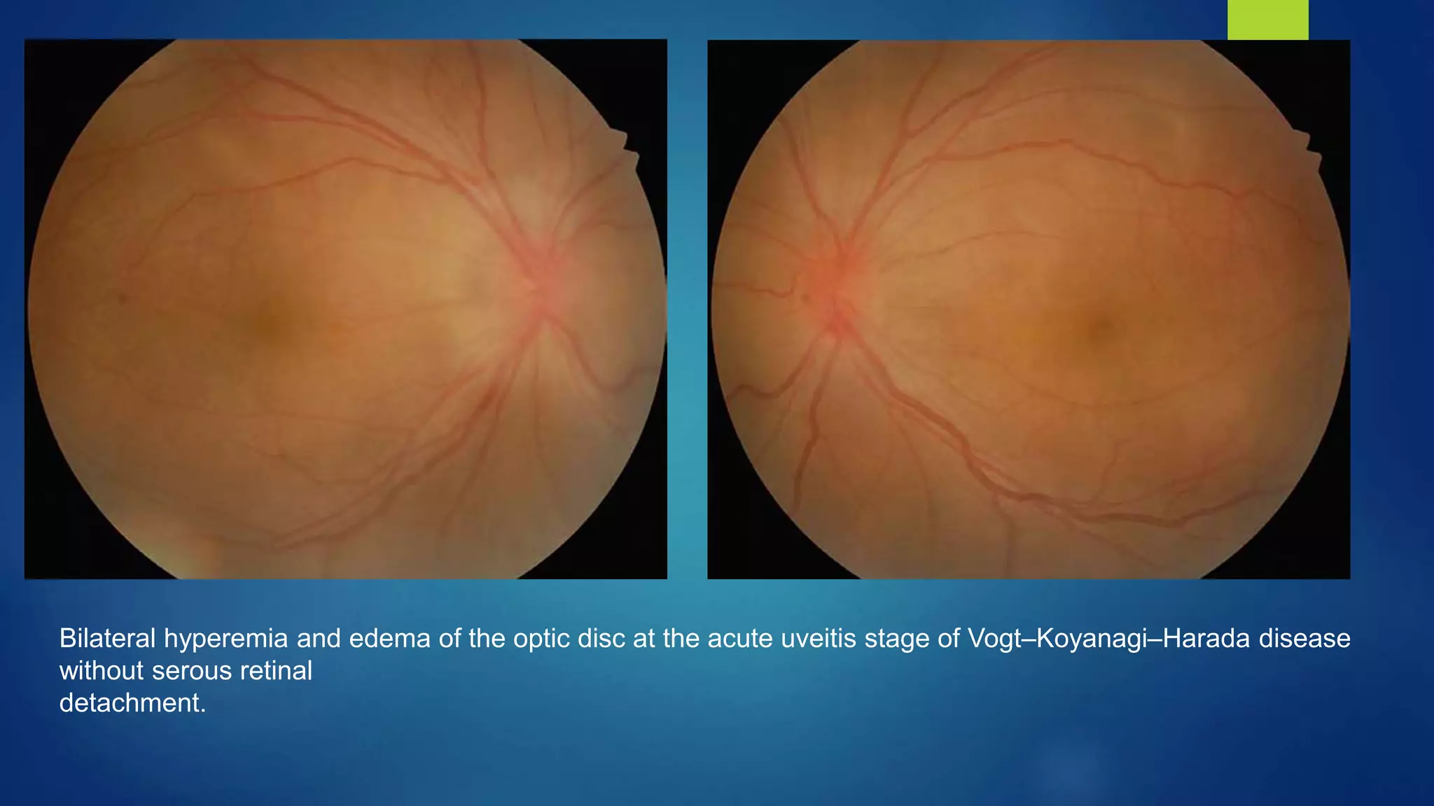 SYMPATHETIC OPHTHALMIA & VKH SYNDROME | PPTX