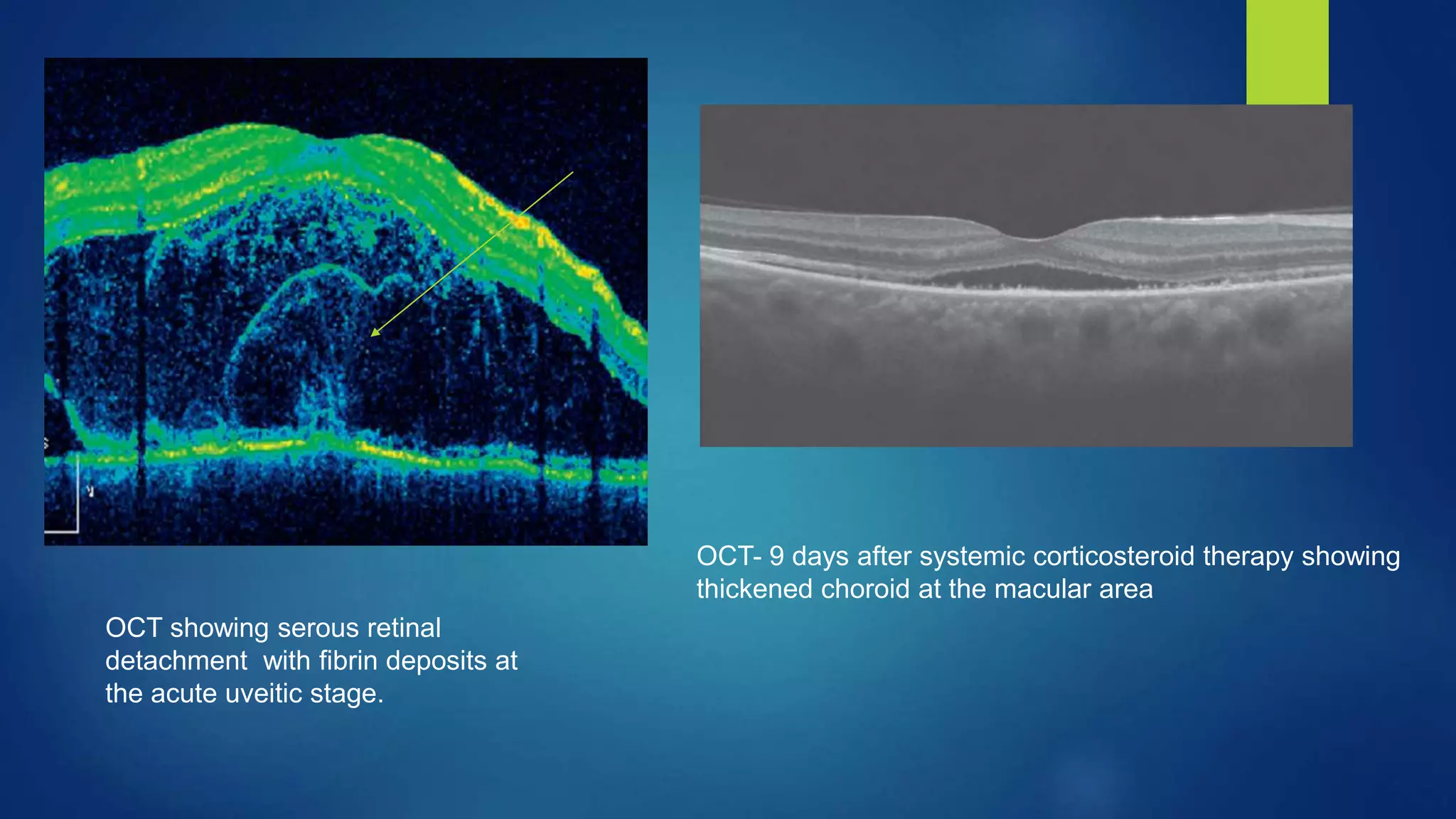 SYMPATHETIC OPHTHALMIA & VKH SYNDROME | PPTX