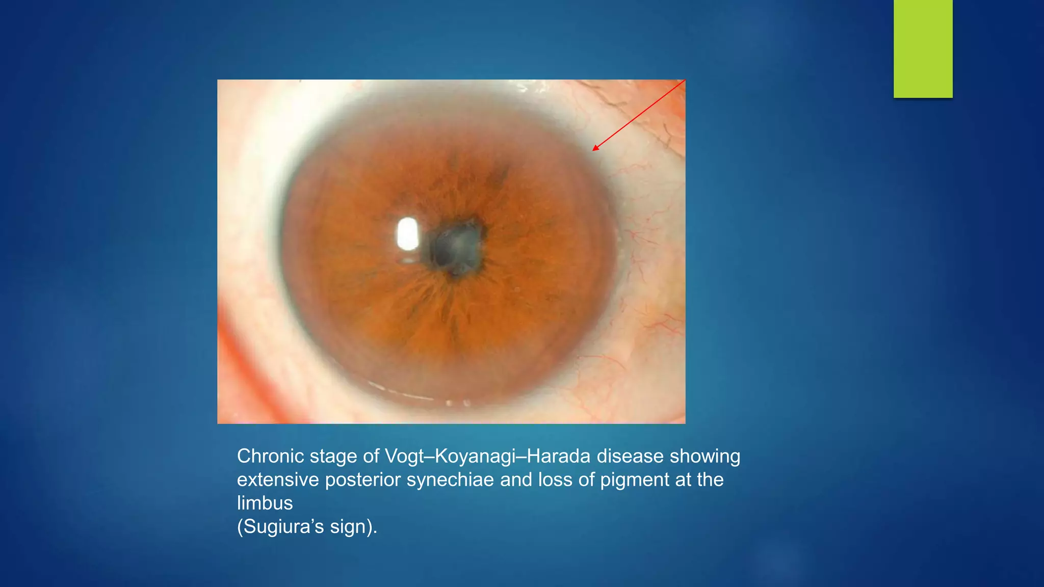 SYMPATHETIC OPHTHALMIA & VKH SYNDROME | PPTX