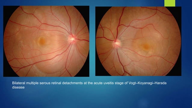SYMPATHETIC OPHTHALMIA & VKH SYNDROME | PPTX | Eye and Vision ...