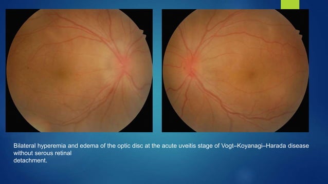 SYMPATHETIC OPHTHALMIA & VKH SYNDROME | PPTX | Eye and Vision ...