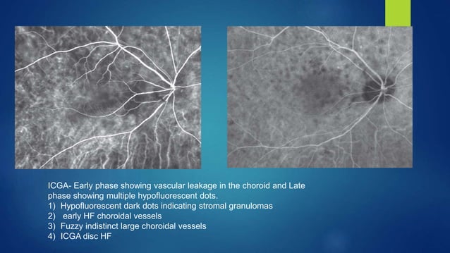 SYMPATHETIC OPHTHALMIA & VKH SYNDROME | PPTX | Eye and Vision ...