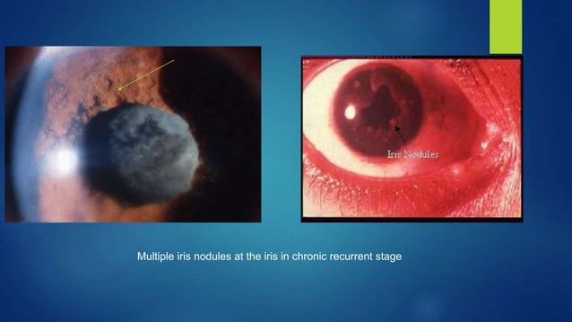 SYMPATHETIC OPHTHALMIA & VKH SYNDROME | PPTX | Eye and Vision ...