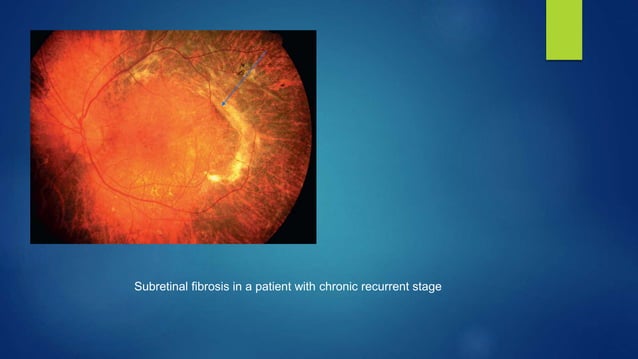 SYMPATHETIC OPHTHALMIA & VKH SYNDROME | PPTX | Eye and Vision ...