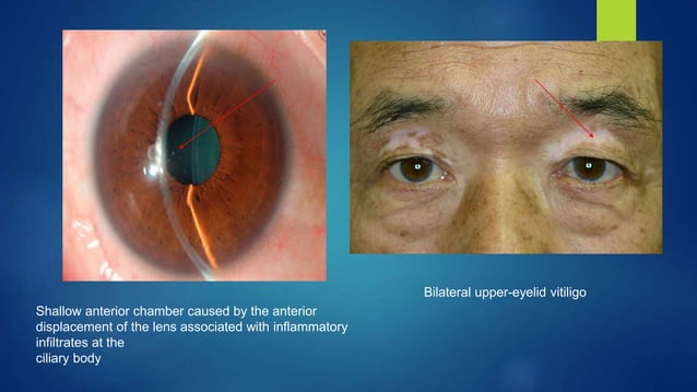 SYMPATHETIC OPHTHALMIA & VKH SYNDROME | PPT