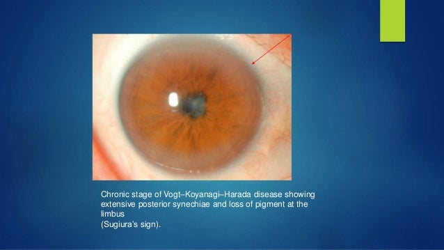 SYMPATHETIC OPHTHALMIA & VKH SYNDROME