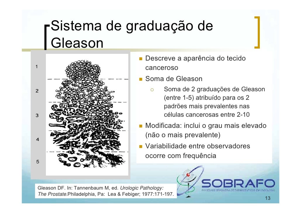 Sobrafo 2009 cancer de prostata - carlos f pinto