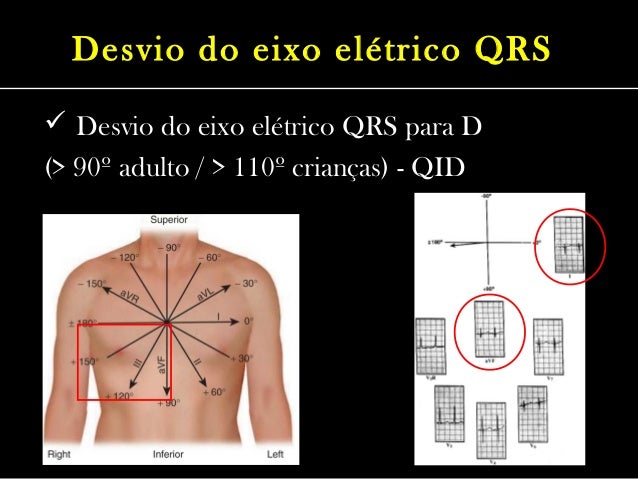 Sobrecargas ventriculares ao ECG - Dra Tatiana Caus