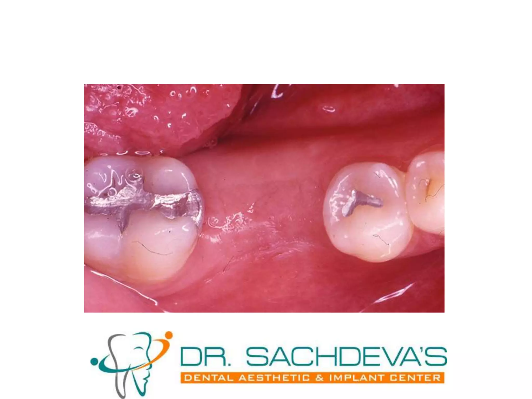 Socket Preservation | Ridge Preservation | PPTX