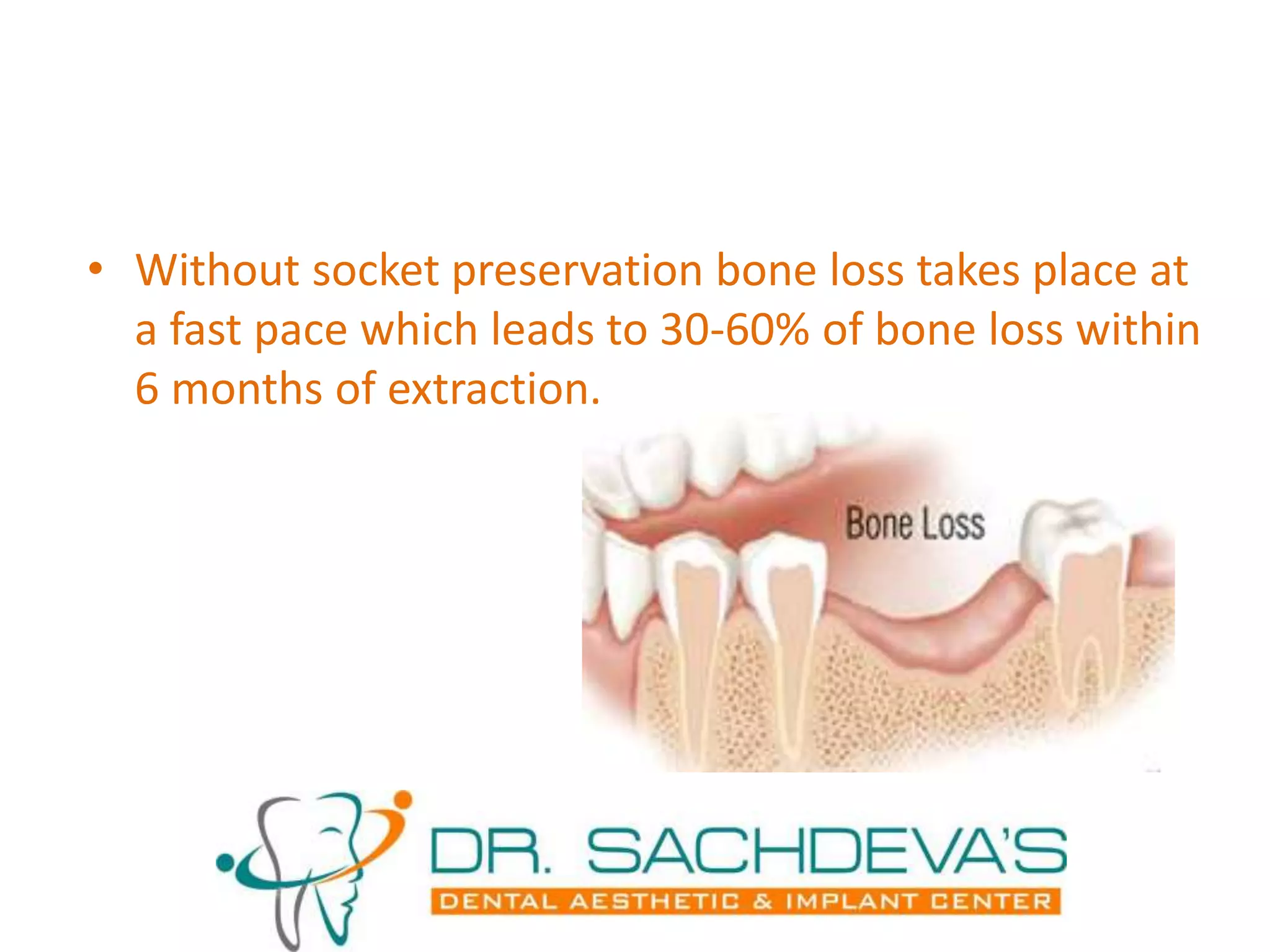 Socket Preservation | Ridge Preservation | PPTX