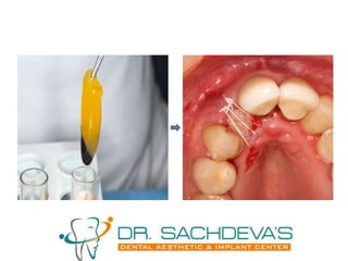 Socket Preservation | Ridge Preservation | PPTX