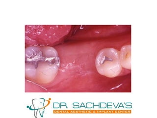 Socket Preservation | Ridge Preservation | PPTX