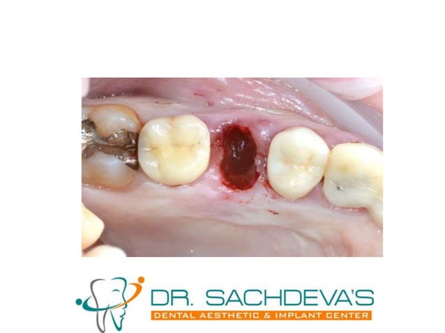 Socket Preservation | Ridge Preservation | PPTX | Dental Health ...