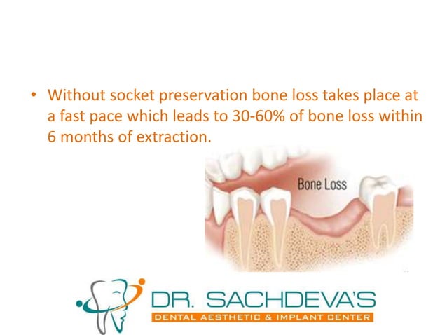 Socket Preservation | Ridge Preservation | PPTX | Dental Health ...