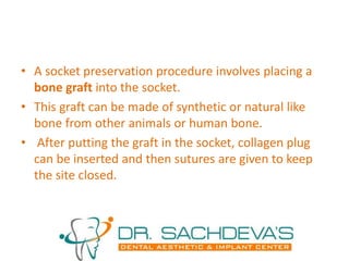 Socket Preservation | Ridge Preservation | PPTX