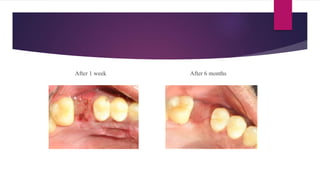 SOCKET PRESERVATION TECHNIQUE- A Case Presentation.pptx