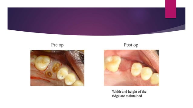 SOCKET PRESERVATION TECHNIQUE- A Case Presentation.pptx