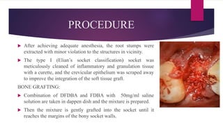 SOCKET PRESERVATION TECHNIQUE- A Case Presentation.pptx