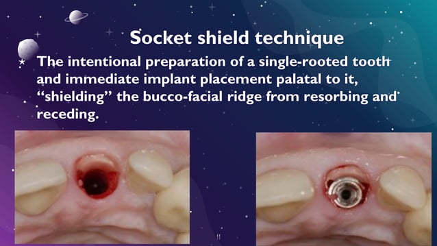 Socket shield | PDF | Dental Health | Diseases and Conditions
