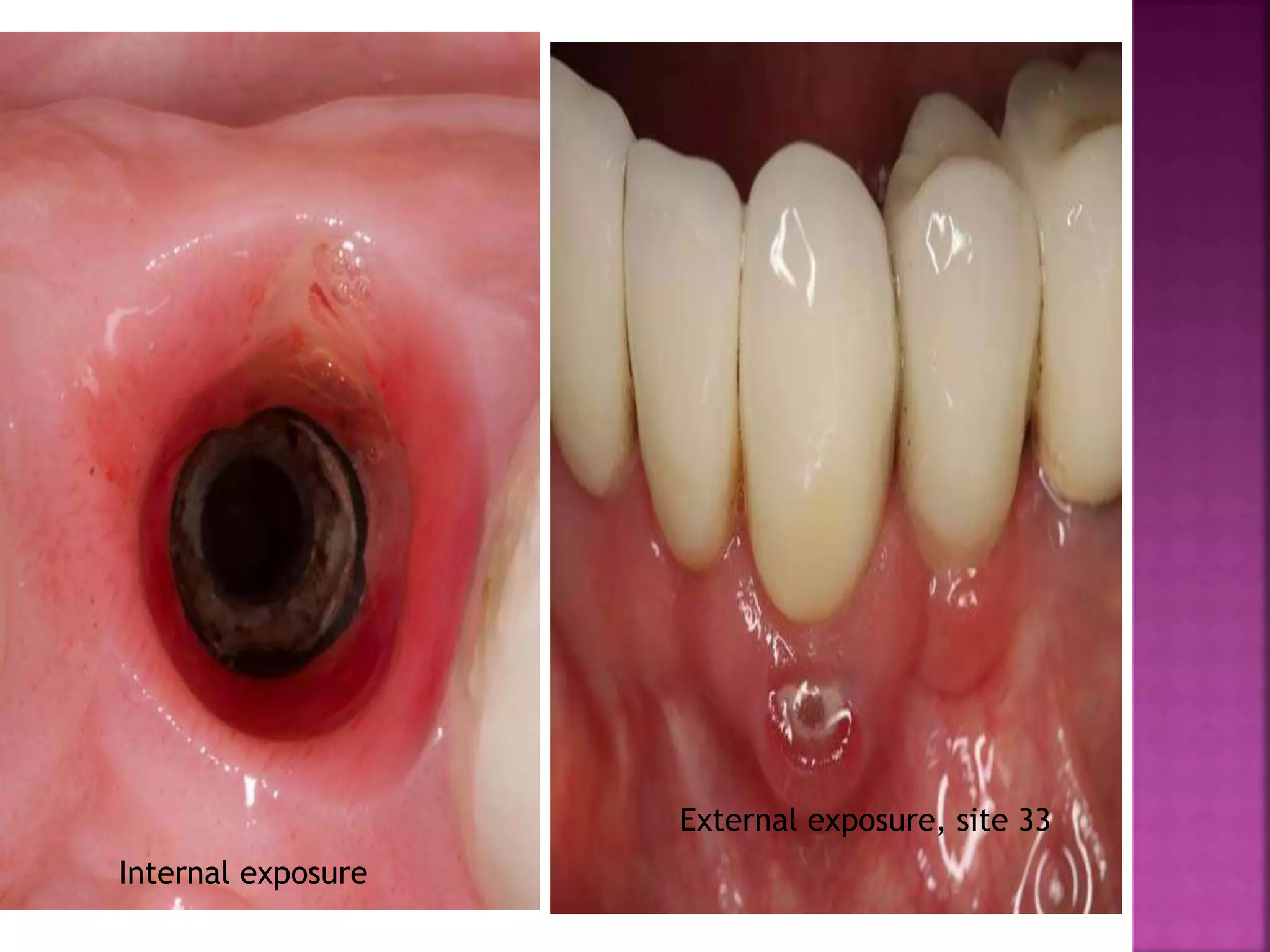 Socket shield jc | PPTX