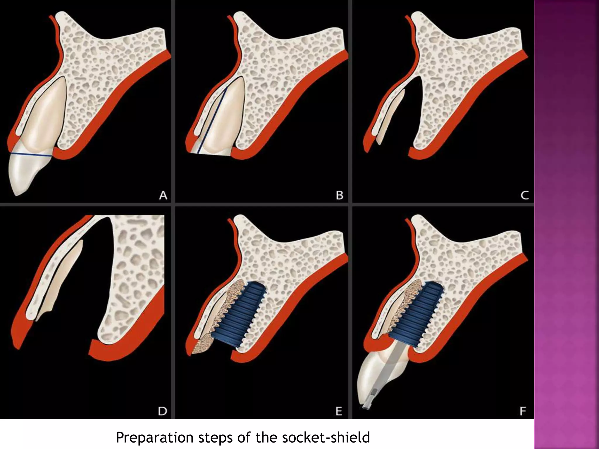 Socket shield jc | PPT