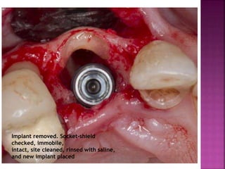 Socket shield jc | PPT