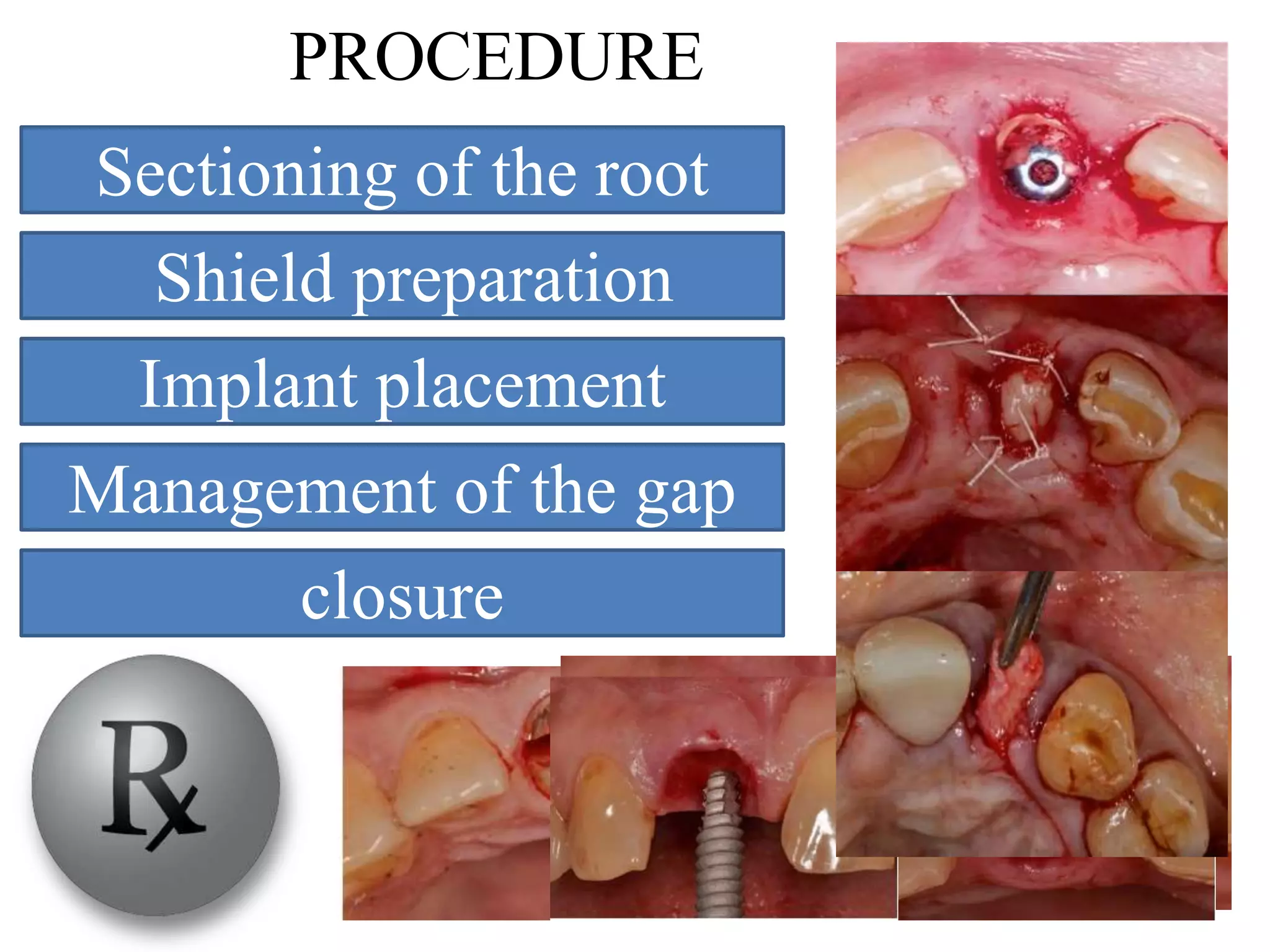 SOCKET SHIELD TECHNIQUE | PPTX