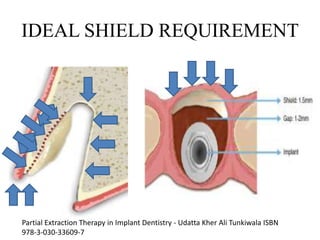SOCKET SHIELD TECHNIQUE | PPTX