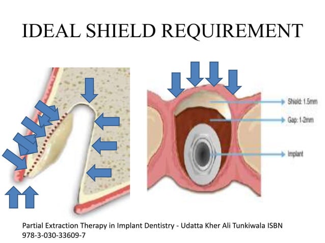 SOCKET SHIELD TECHNIQUE | PPTX | Dental Health | Diseases and Conditions