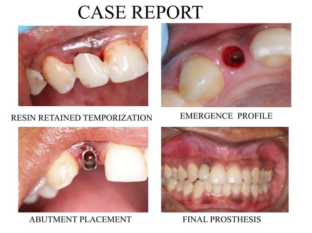 SOCKET SHIELD TECHNIQUE | PPTX | Dental Health | Diseases and Conditions