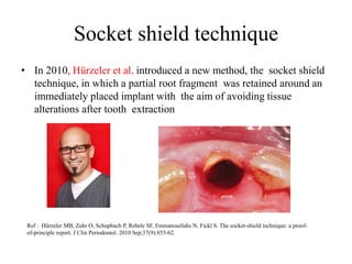 SOCKET SHIELD TECHNIQUE | PPTX
