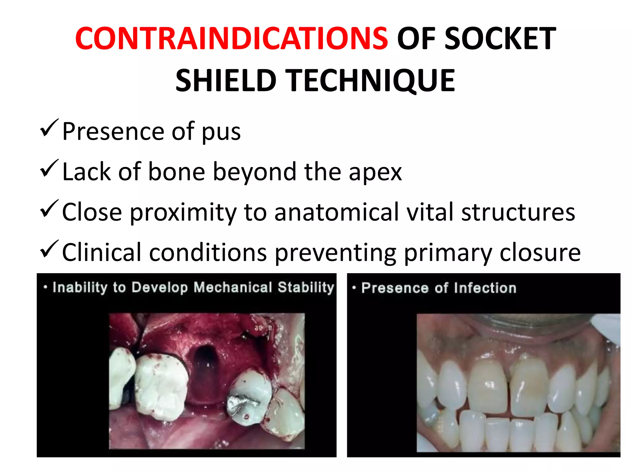 Socket Shield Technique Pptx