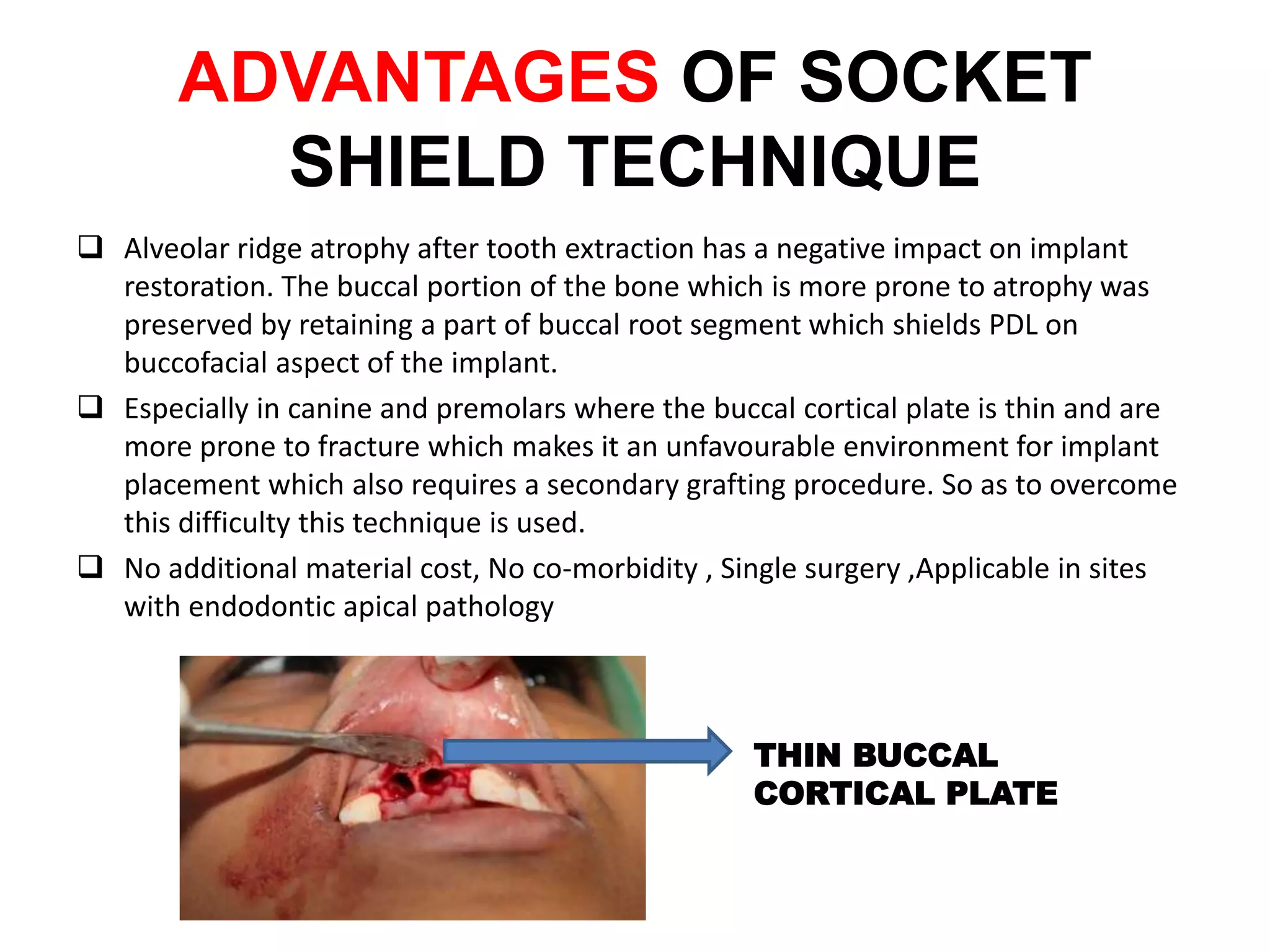 Socket shield technique | PPTX