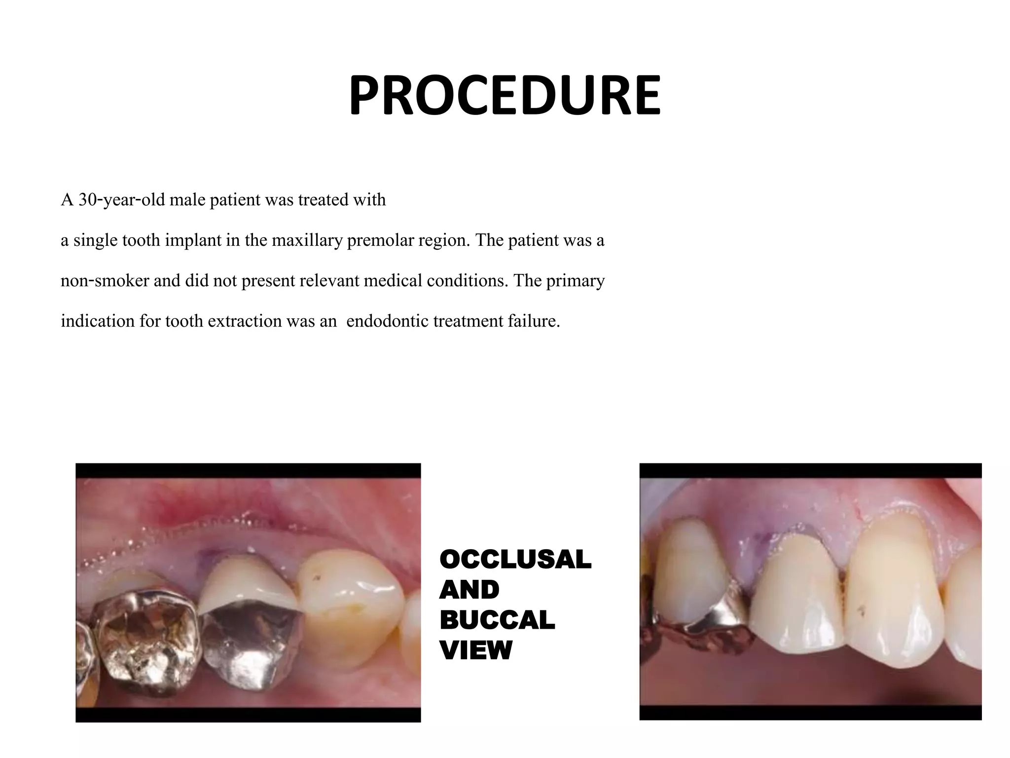 Socket shield technique | PPTX