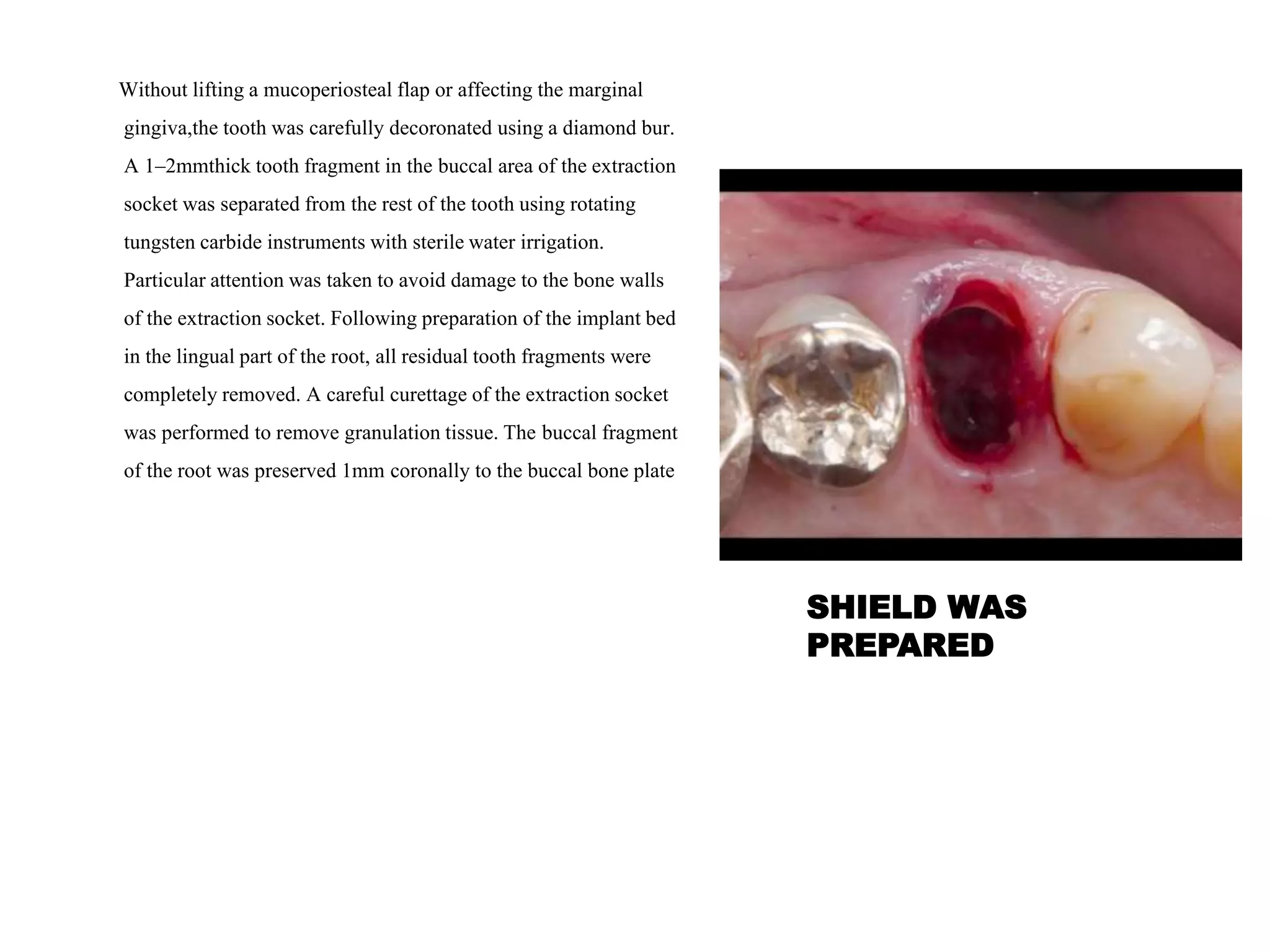 Socket shield technique | PPTX