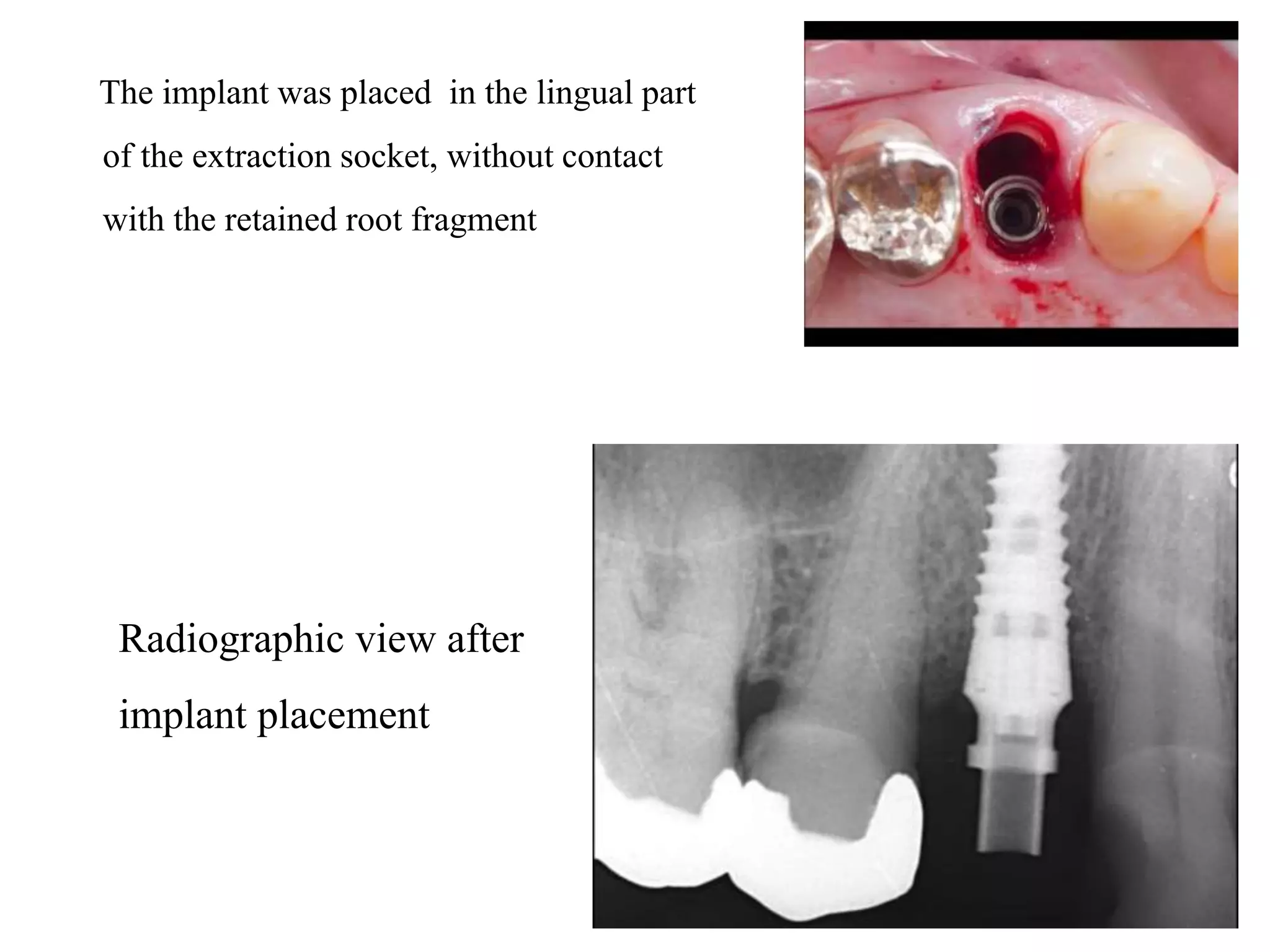 Socket shield technique | PPTX