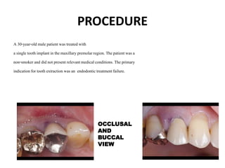 Socket shield technique | PPTX