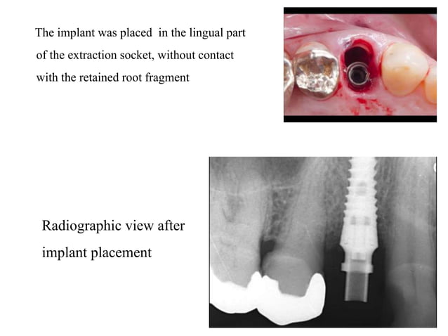 Socket shield technique | PPTX