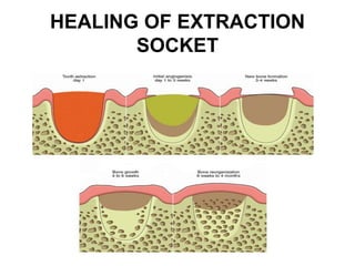Socket shield technique | PPTX