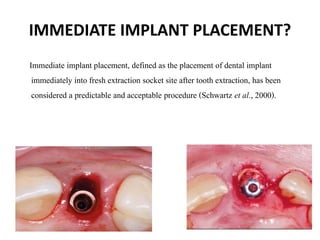 Socket shield technique | PPTX