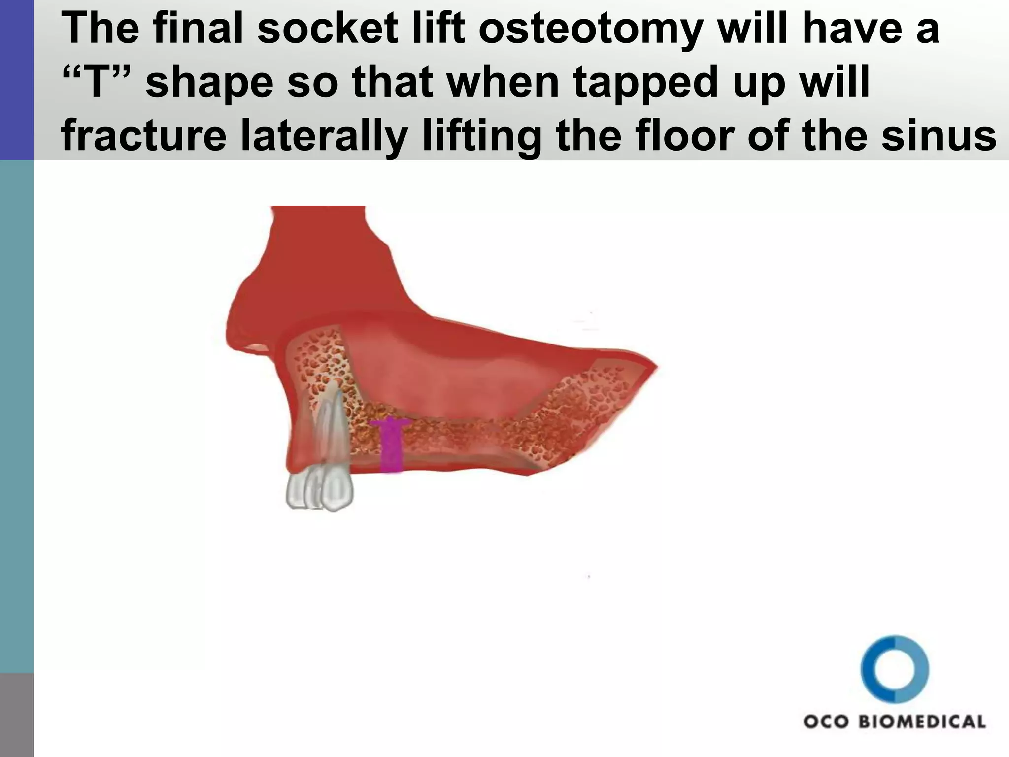 Socket sinus lift | PPTX