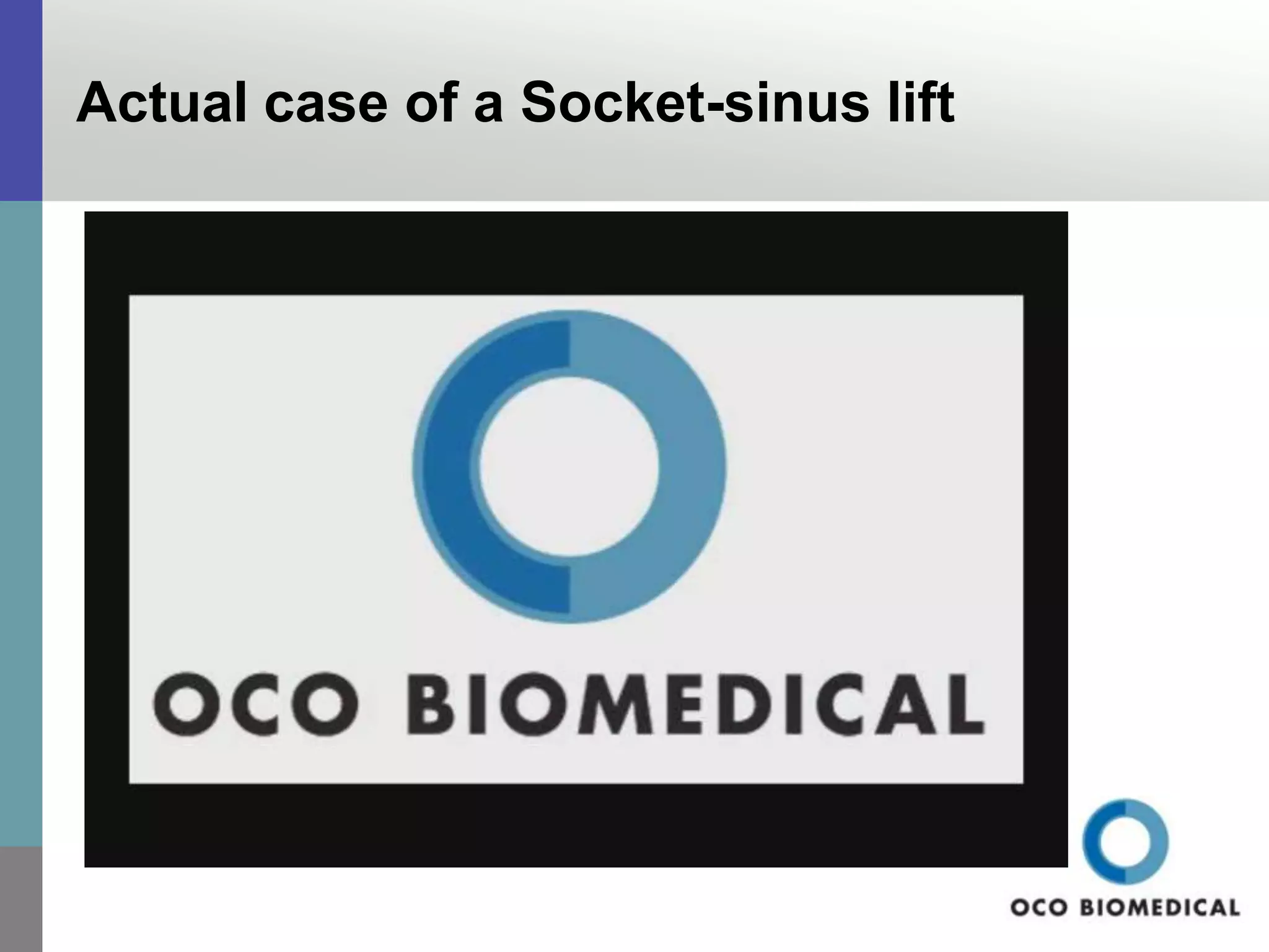 Socket sinus lift | PPTX
